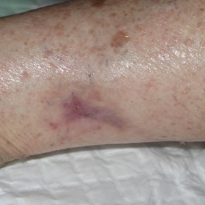 Martorell ulcer 2 - Elena Conde