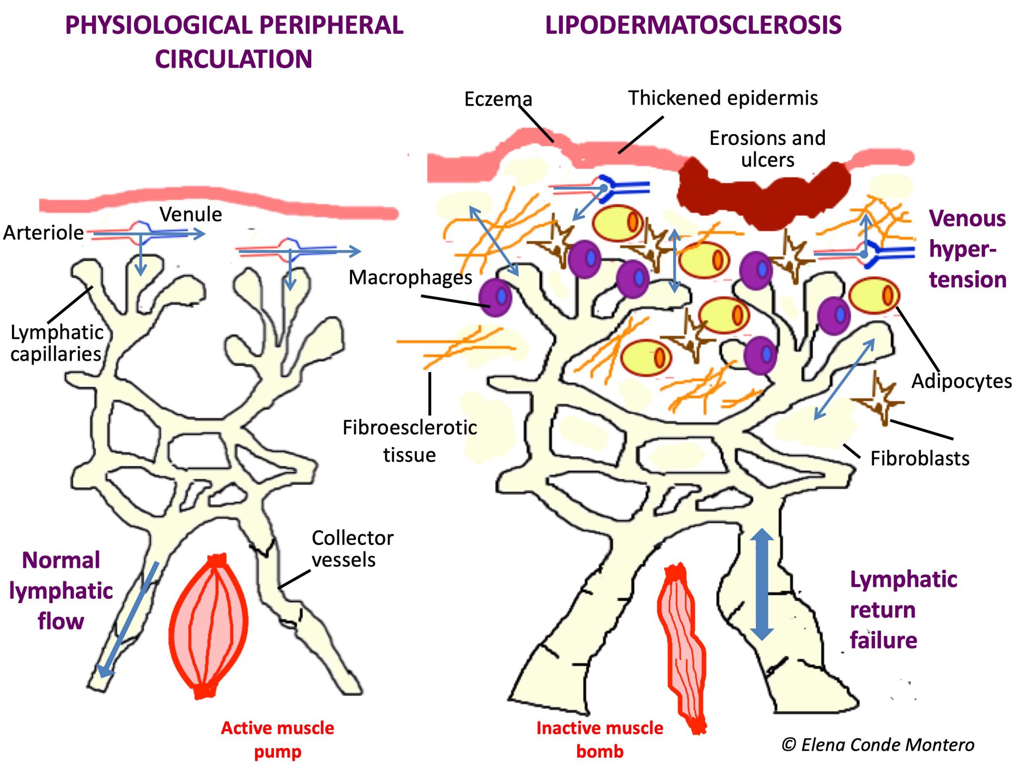 Phlebolymphedema, a term that should be more used - Elena Conde